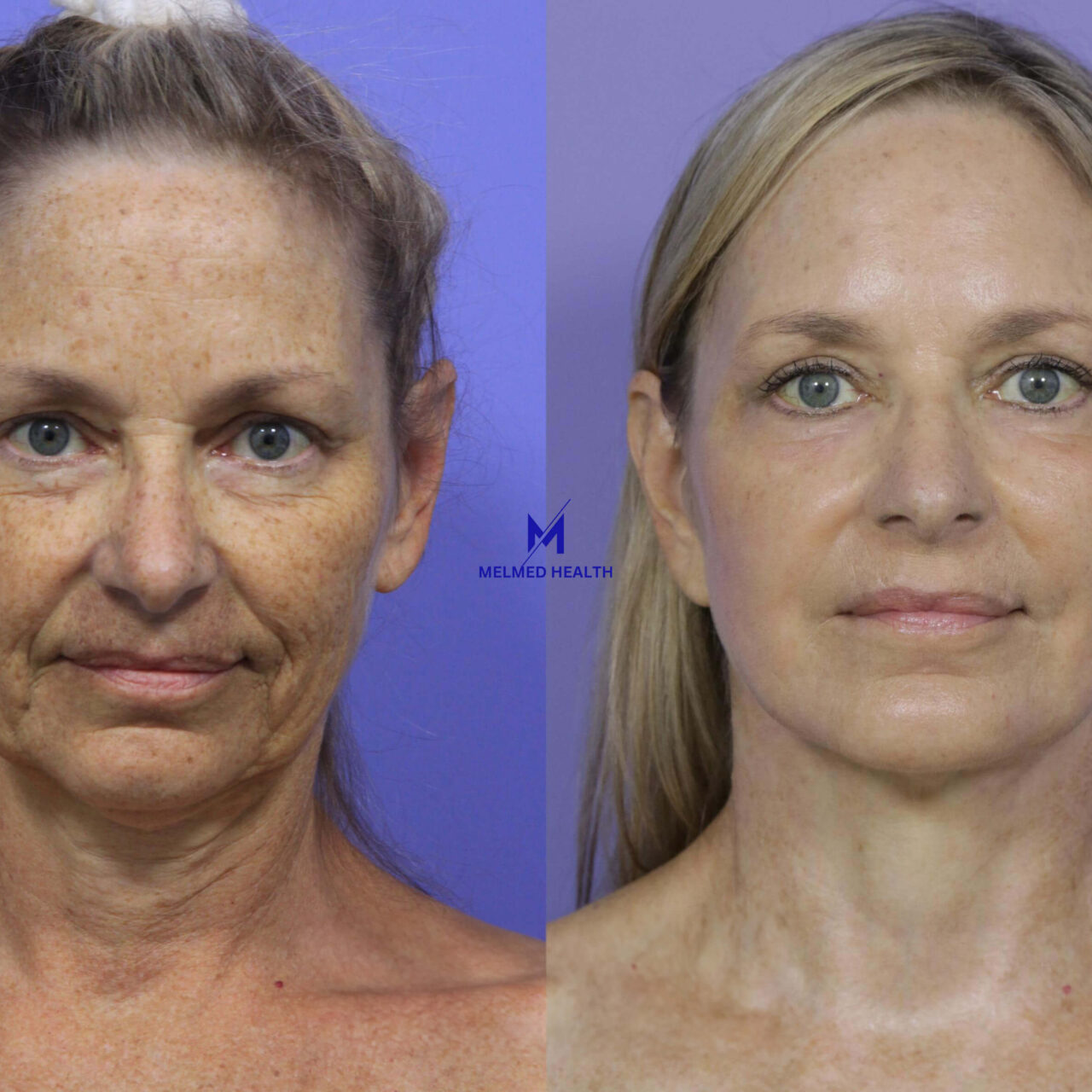 Neck Liposuction - Melmed Health